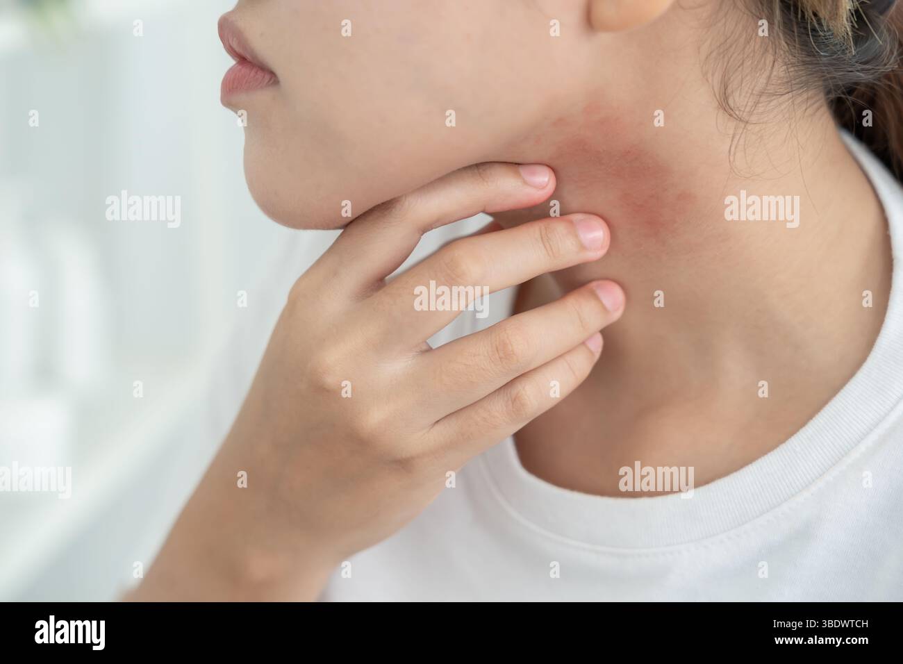 skin problem and beauty. woman scratch body has itchy skin from skin ...