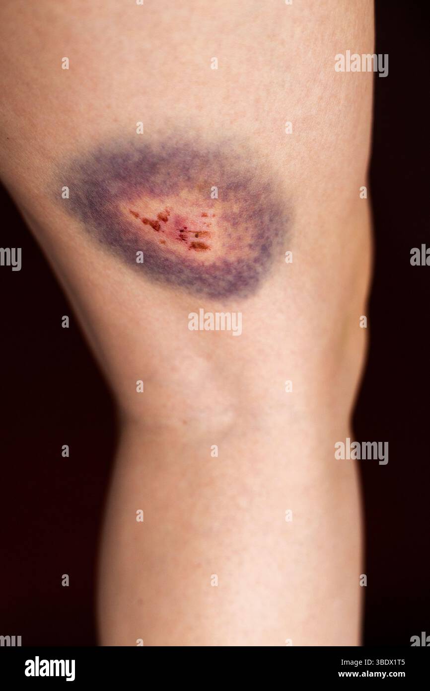 Dog bite wound hi-res stock photography and images - Alamy