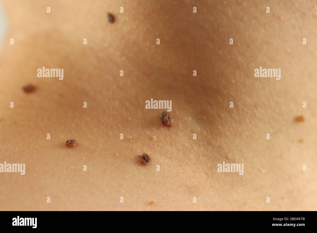 Woman with moles on her skin, closeup Stock Photo - Alamy