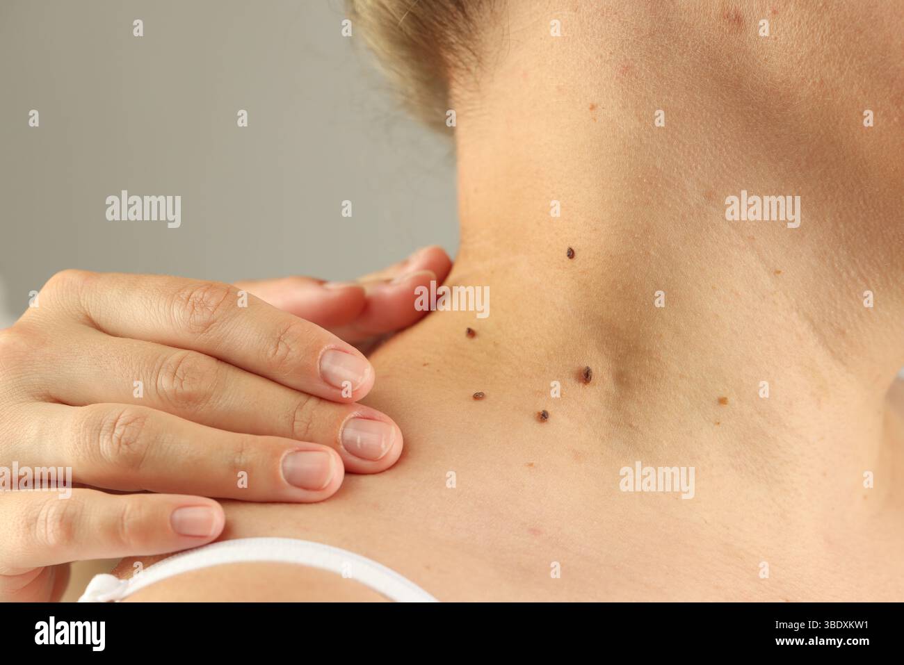 Doctor examining woman's moles on light grey background, closeup Stock ...