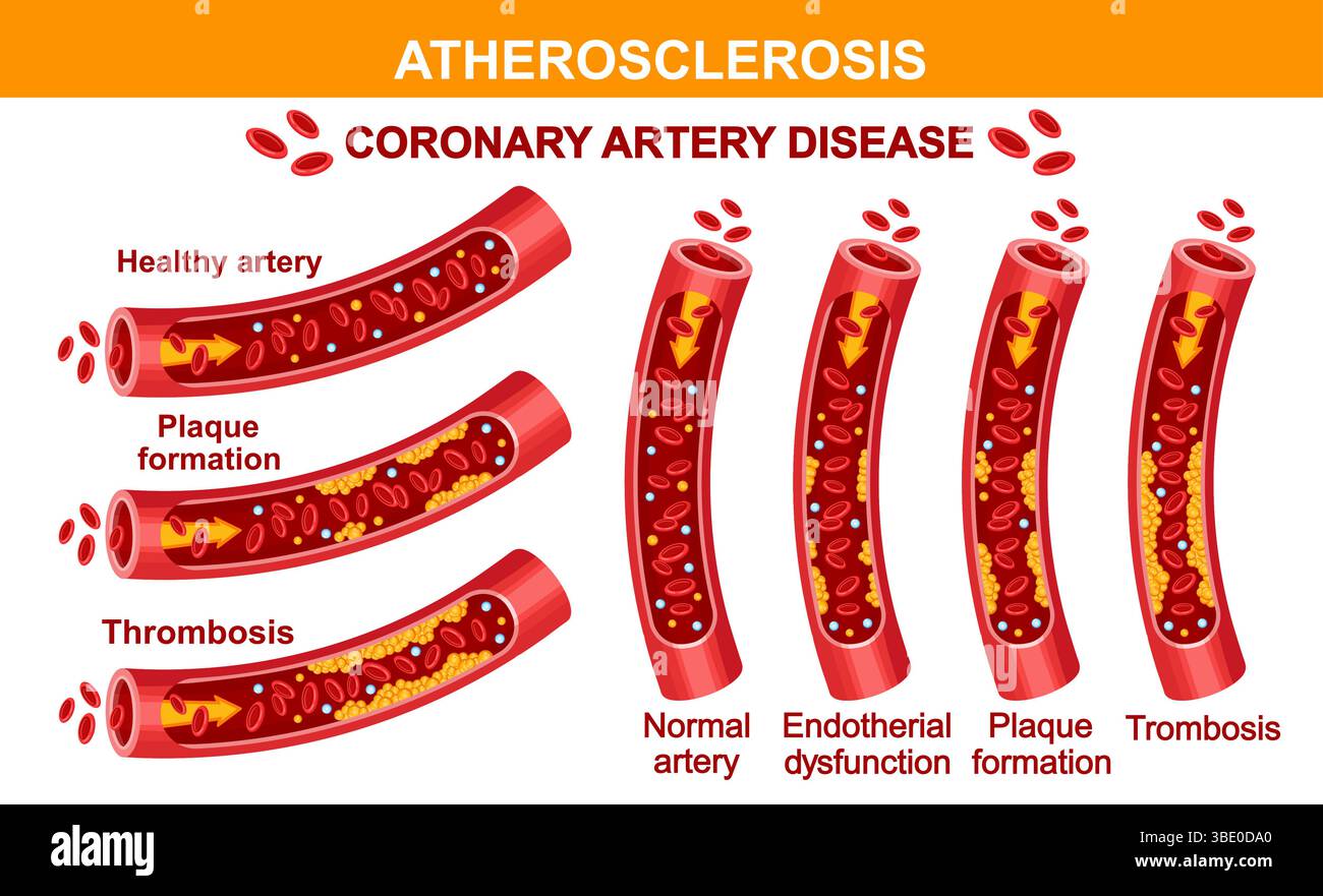 Atherosclerosis coronary artery disease, block arterial blood vessel ...