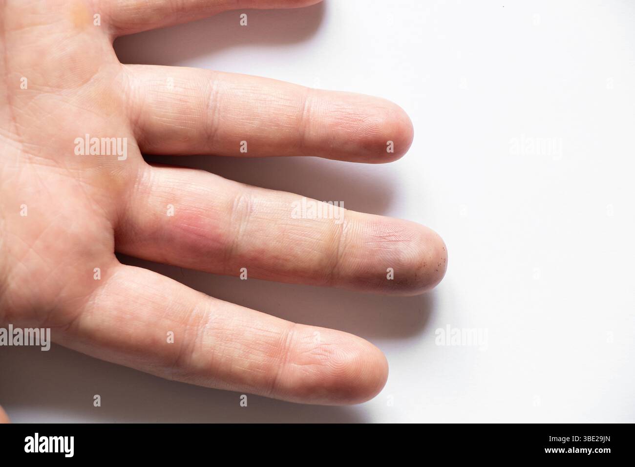 Broken male finger on hand on white background, fracture and accident ...