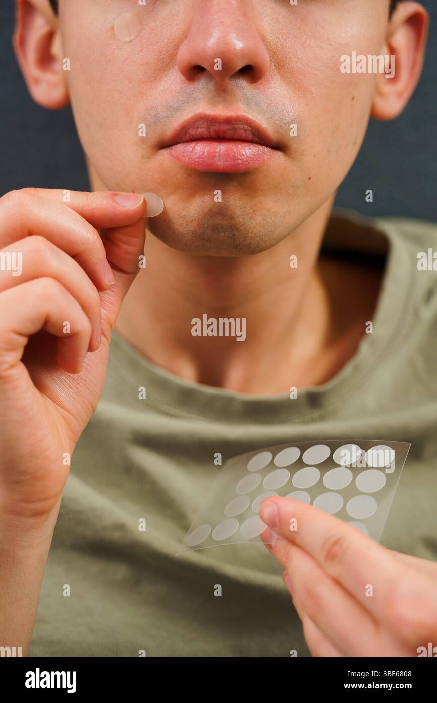 Male facial beauty concept. Using acne pimple patch to clean the face ...