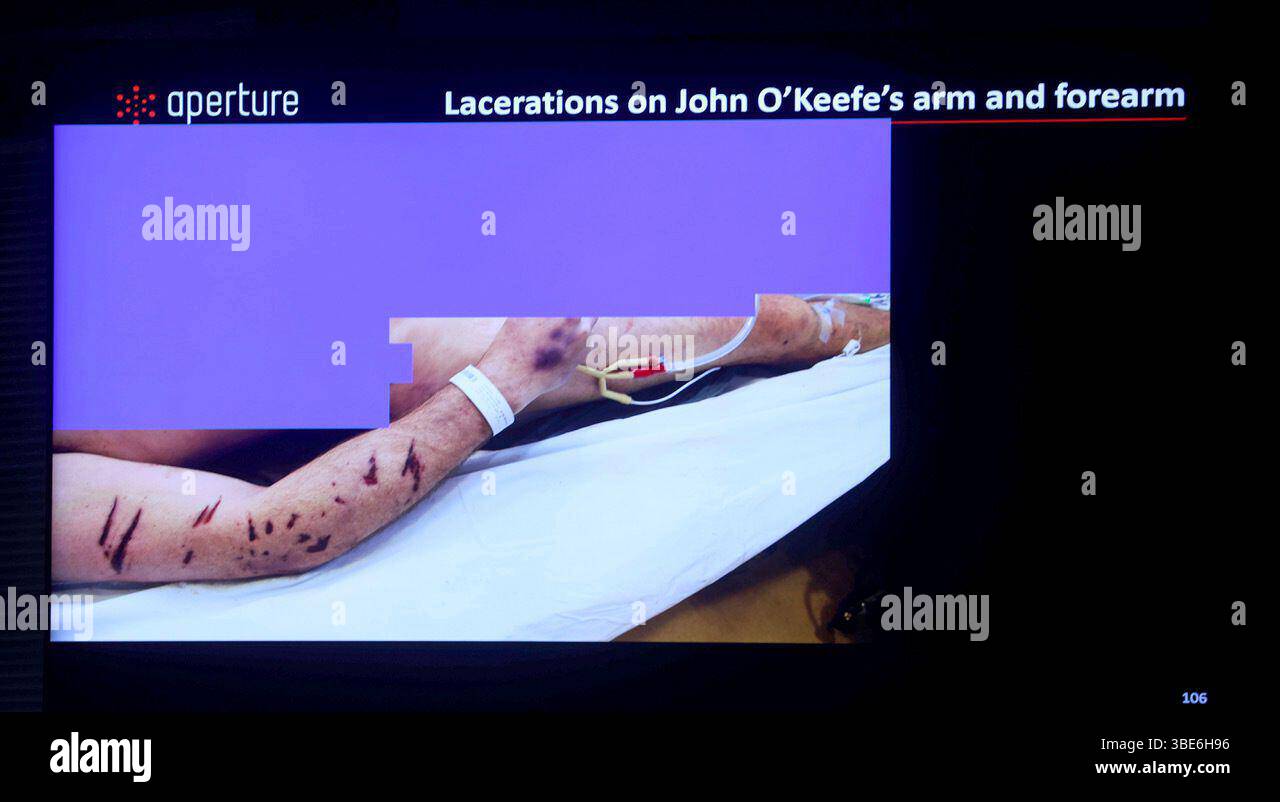 A slide of John O'Keefe's arm is displayed during the Karen Read trial ...
