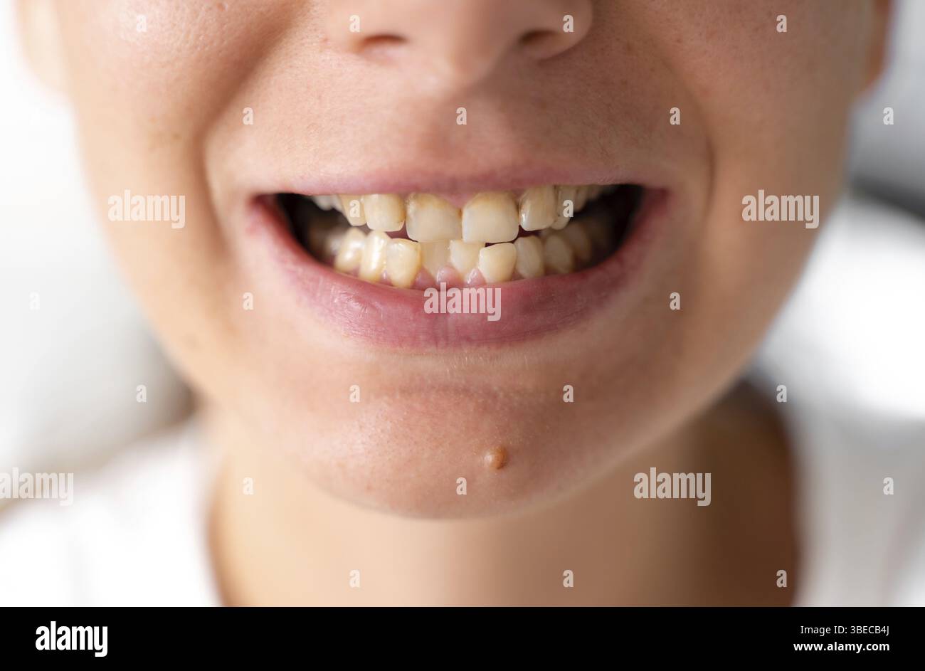 Crooked and yellow teeth. Woman has malocclusion. Adult orthodontics ...