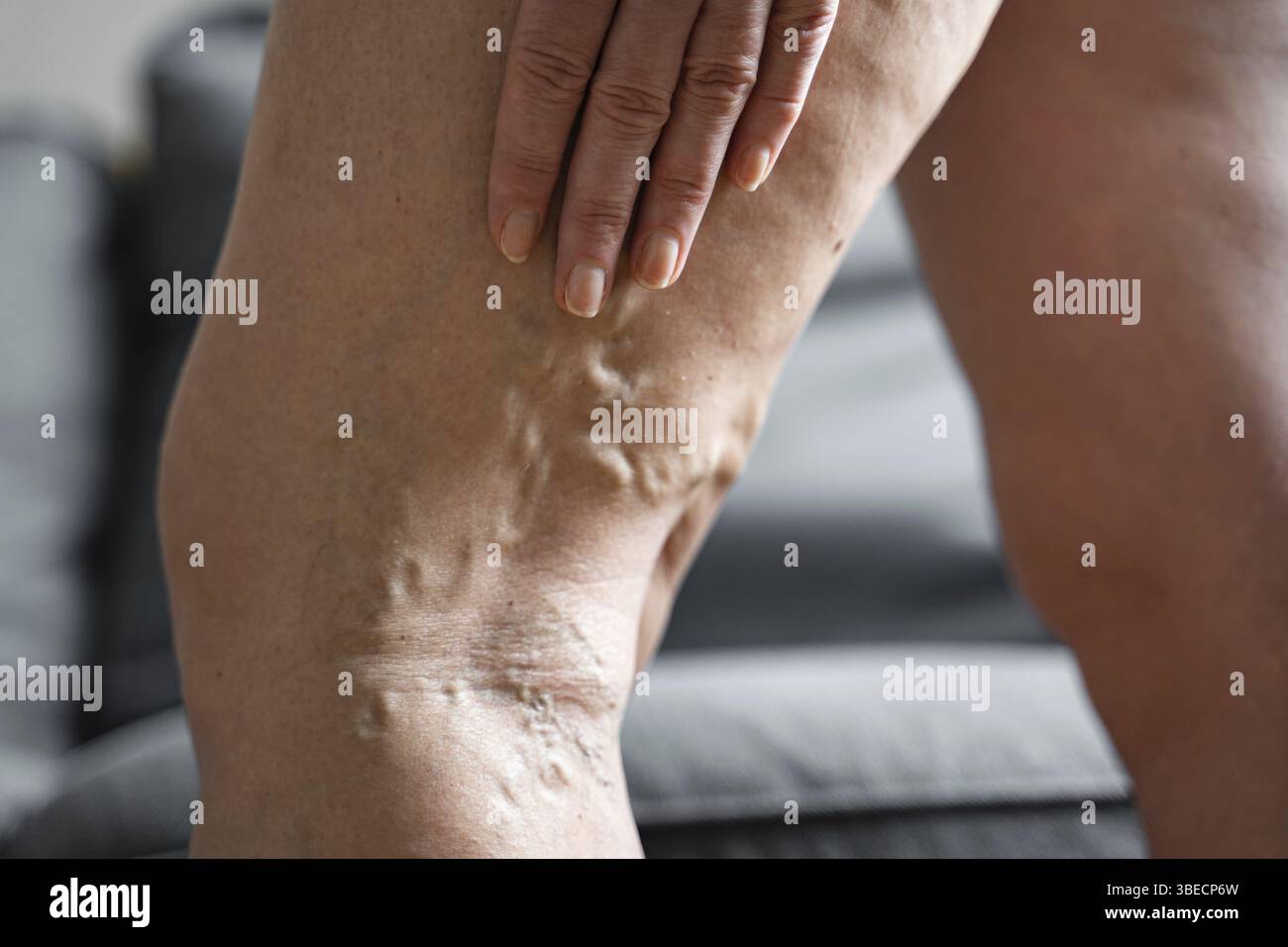 Varicose vein close up leg. Senior woman health problem. Foot with Diseased Veins. Health Care ...