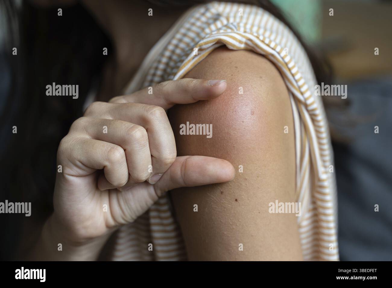 Side effect of the vaccine - shoulder skin redness and pain. Covid-19 ...