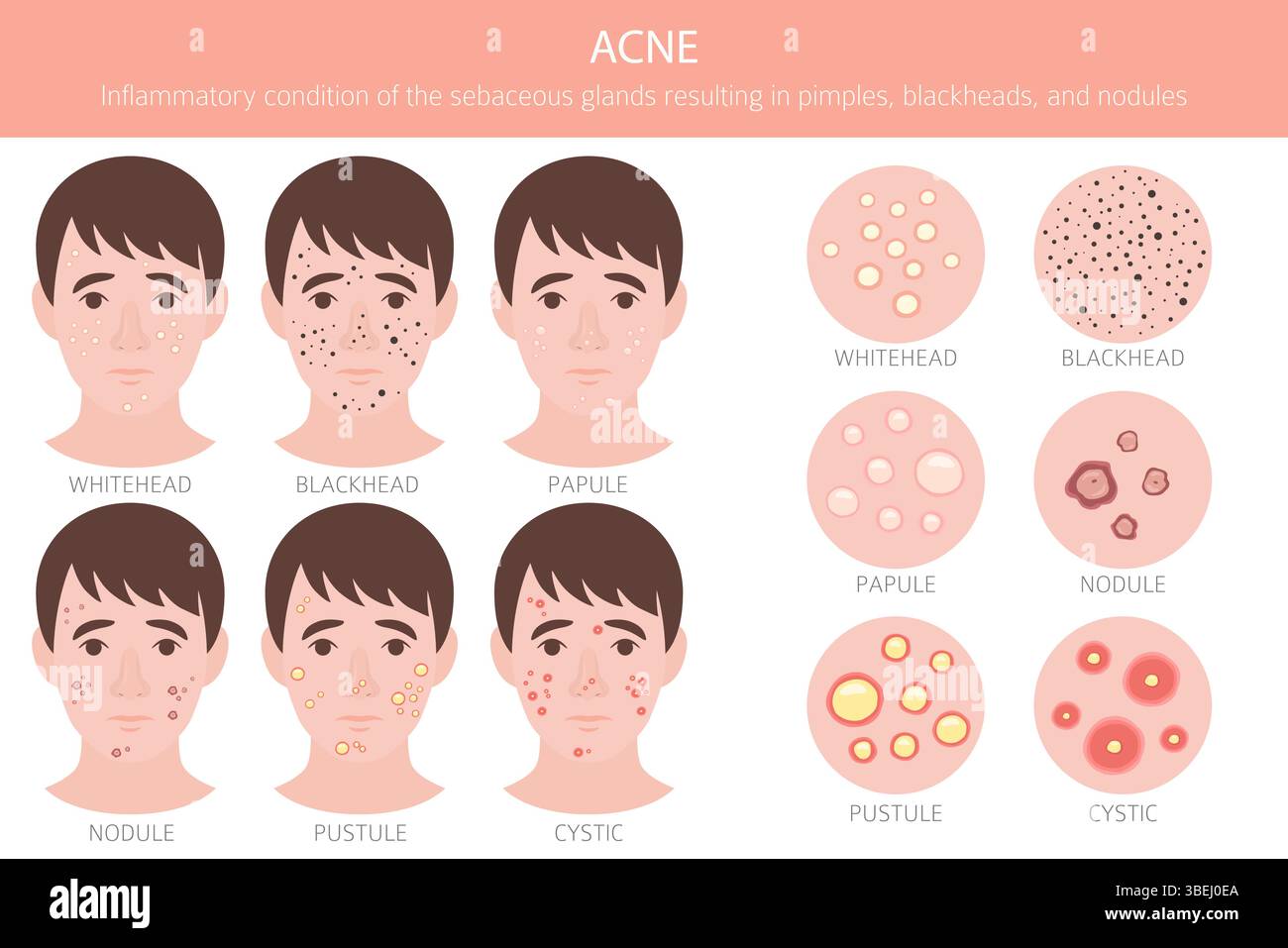 Acne skin condition. Skin diseases. Medical infographic design. Vector ...