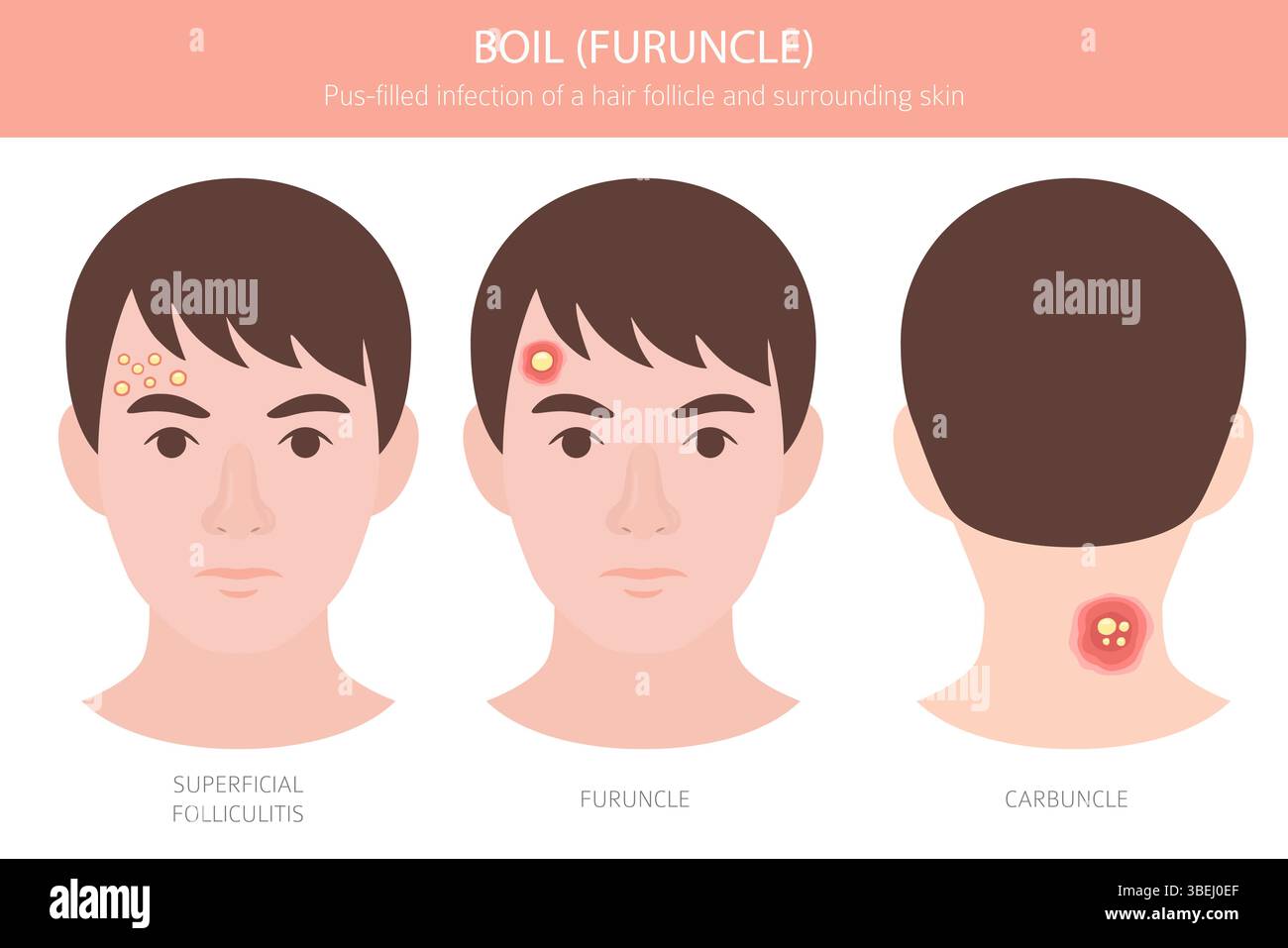 Furuncle vector vectors Stock Vector Images - Alamy