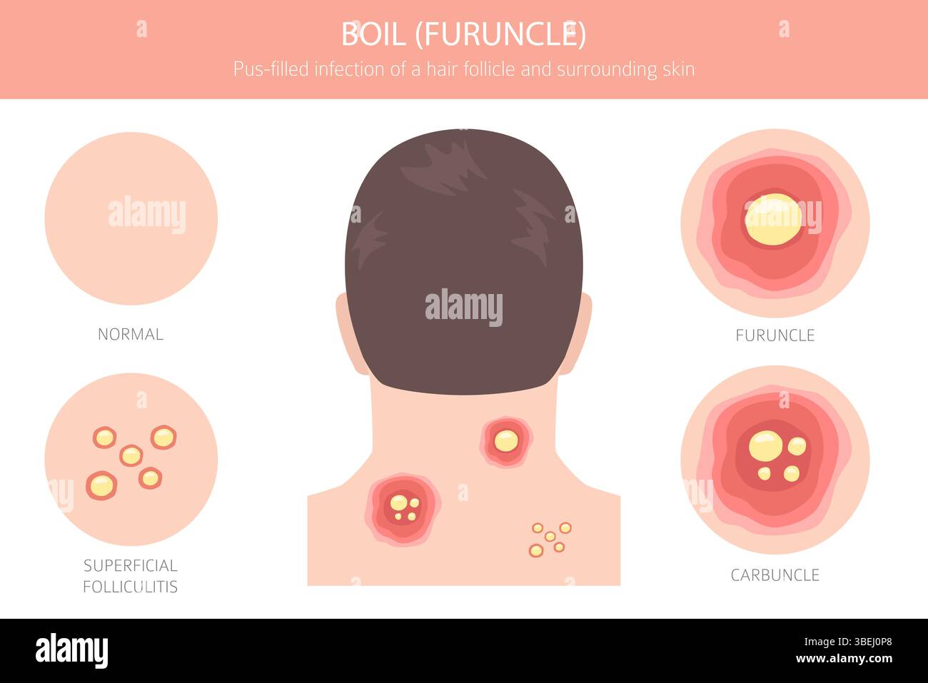 Boil, Furuncle, carbuncle. Skin diseases. Medical infographic design ...