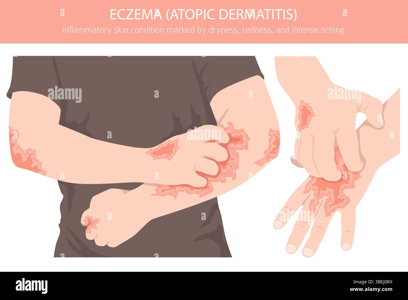 Eczema vector vectors hi-res stock photography and images - Alamy