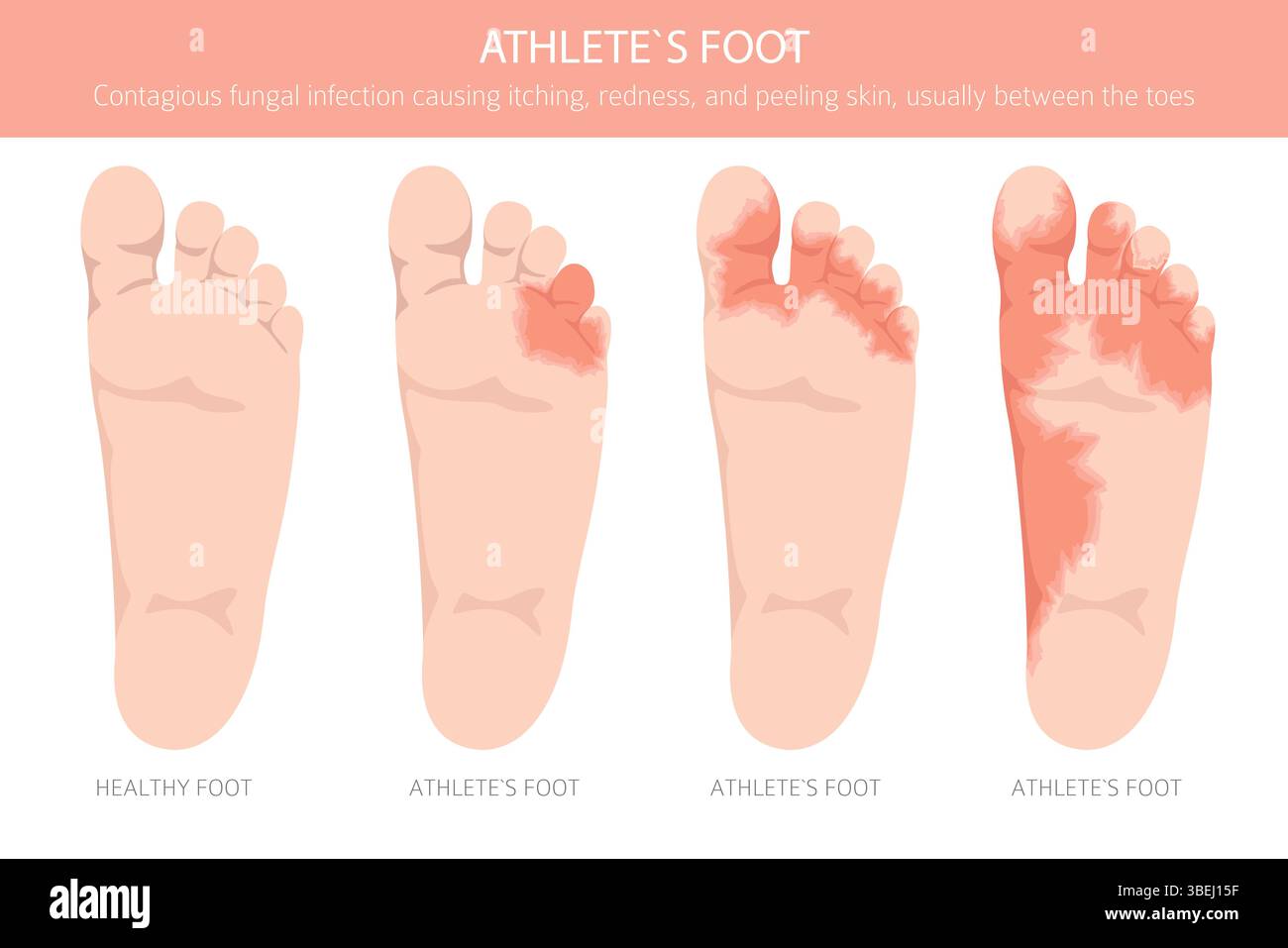 Athlete`s foot. Tinea pedis skin condition. Skin diseases. Medical ...