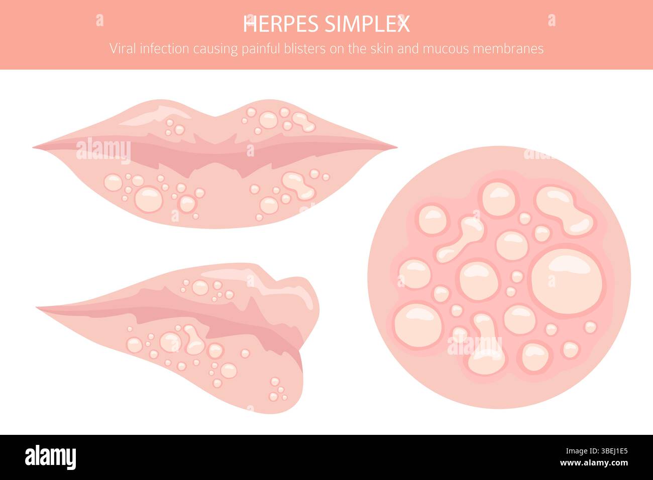 Herpes Simplex. Skin diseases. Medical infographic design. Vector illustration Stock Vector ...