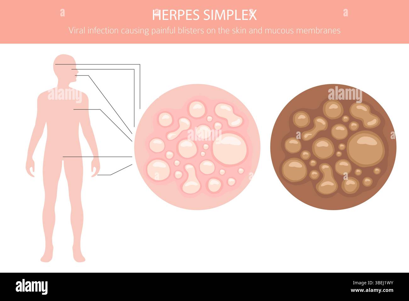 Herpes Simplex. Skin diseases. Medical infographic design. Vector ...
