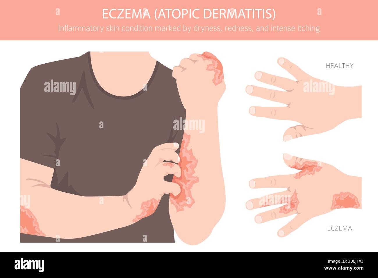 Eczema. Atopic dermatitis. Skin diseases. Medical infographic design ...