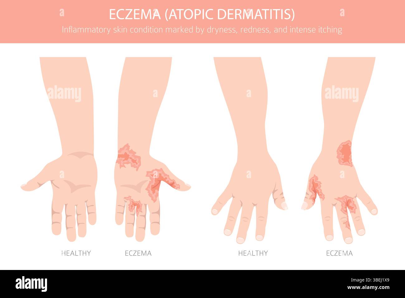 Eczema. Atopic dermatitis. Skin diseases. Medical infographic design ...