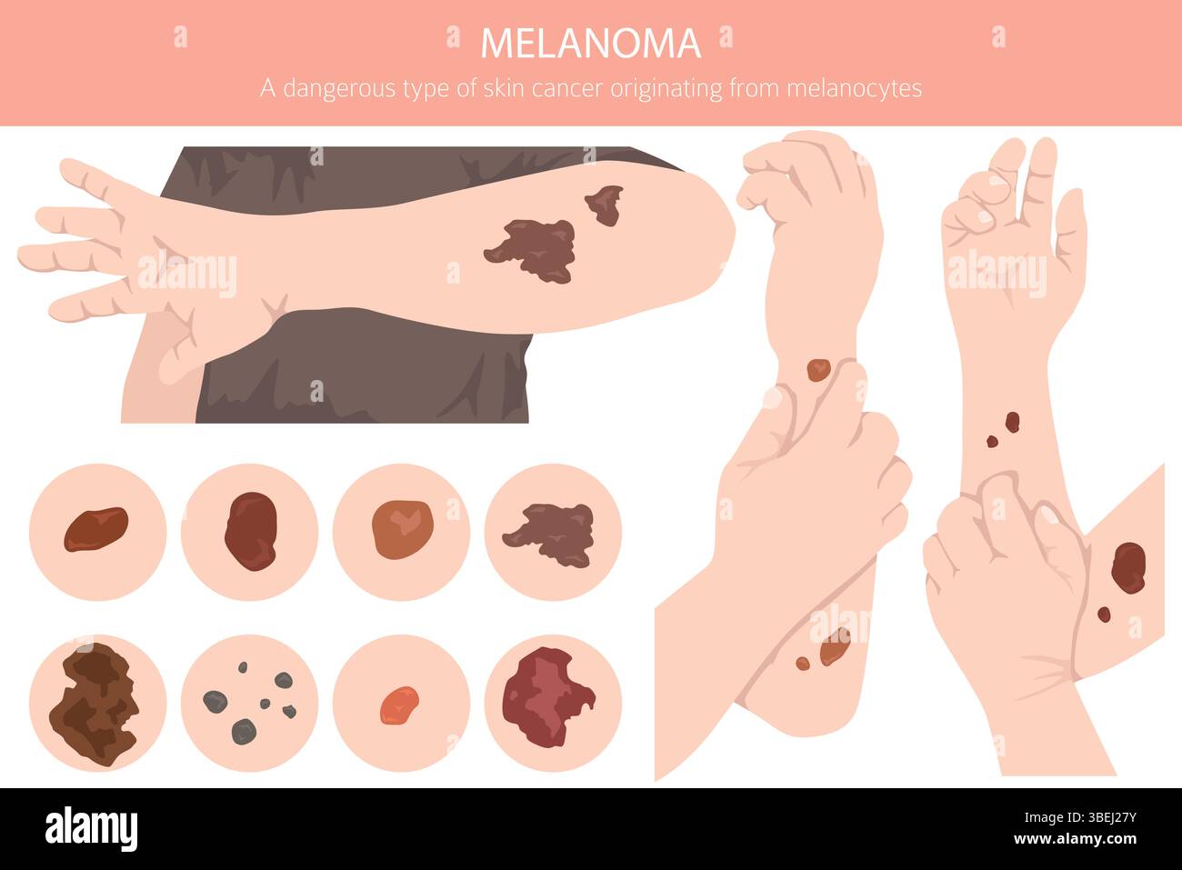 Melanoma. Skin diseases. Medical infographic design. Vector illustration Stock Vector Image ...