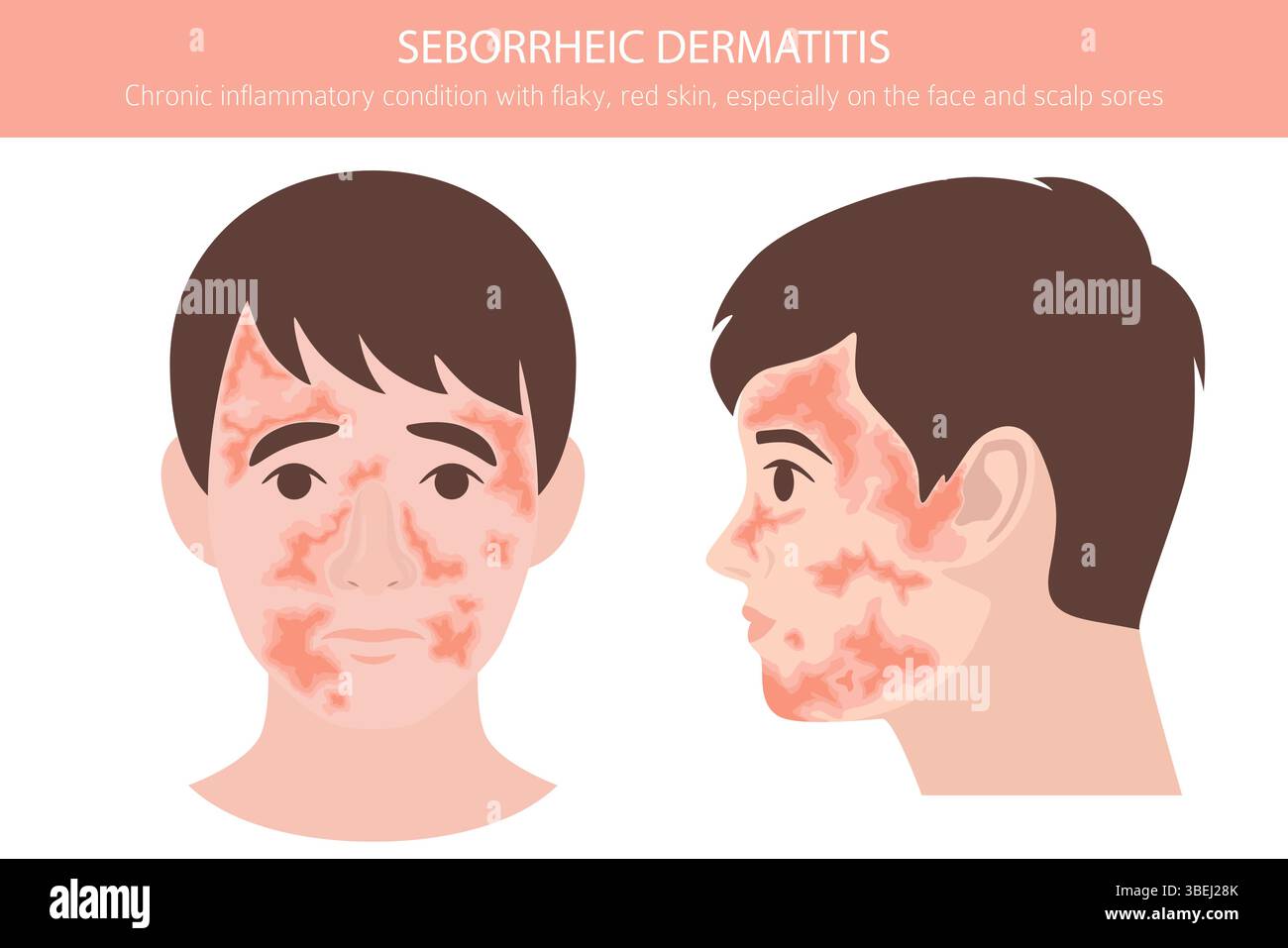 Seborrheic dermatitis. Skin diseases. Medical infographic design ...