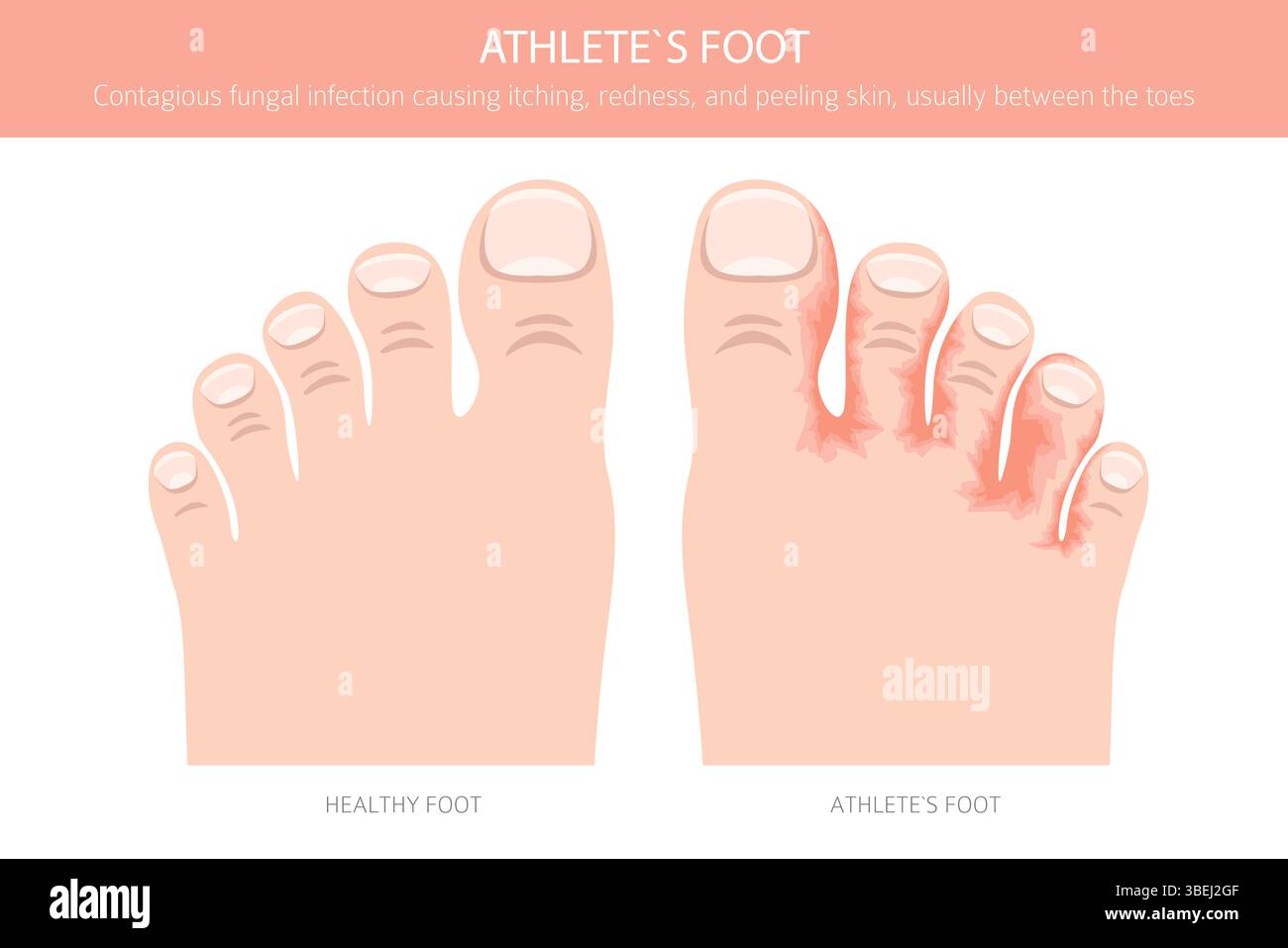 Athlete`s foot. Tinea pedis skin condition. Skin diseases. Medical ...