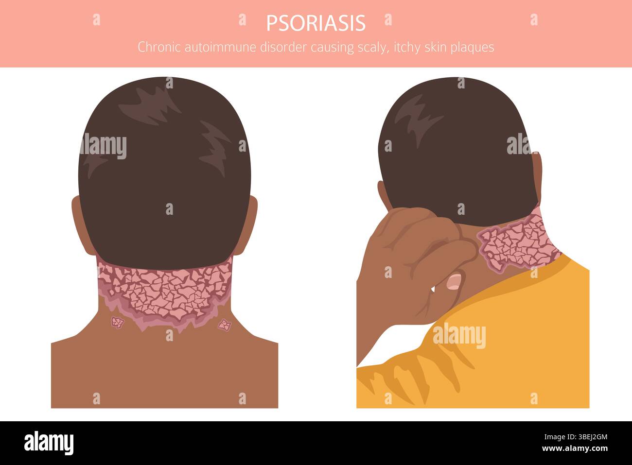 Psoriasis. Skin diseases. Medical infographic design. Vector ...