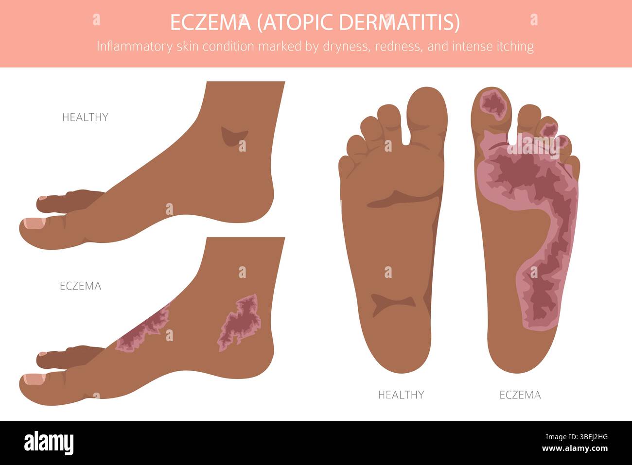 Eczema. Atopic dermatitis. Skin diseases. Medical infographic design ...