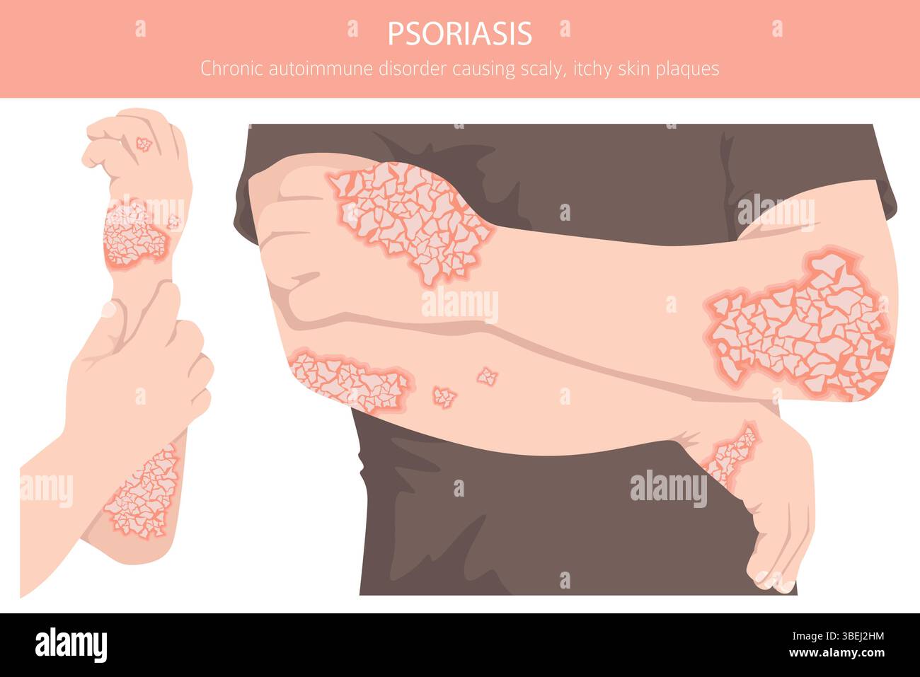 Psoriasis. Skin diseases. Medical infographic design. Vector illustration Stock Vector Image ...