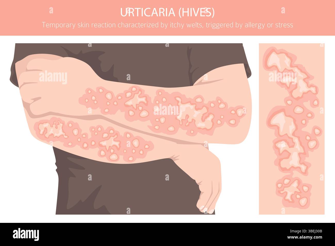 Urticaria. Hives. Skin diseases. Medical infographic design. Vector ...