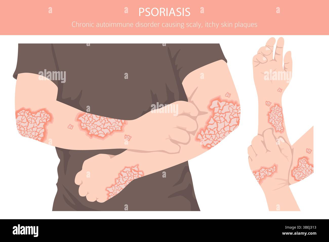 Psoriasis. Skin diseases. Medical infographic design. Vector ...