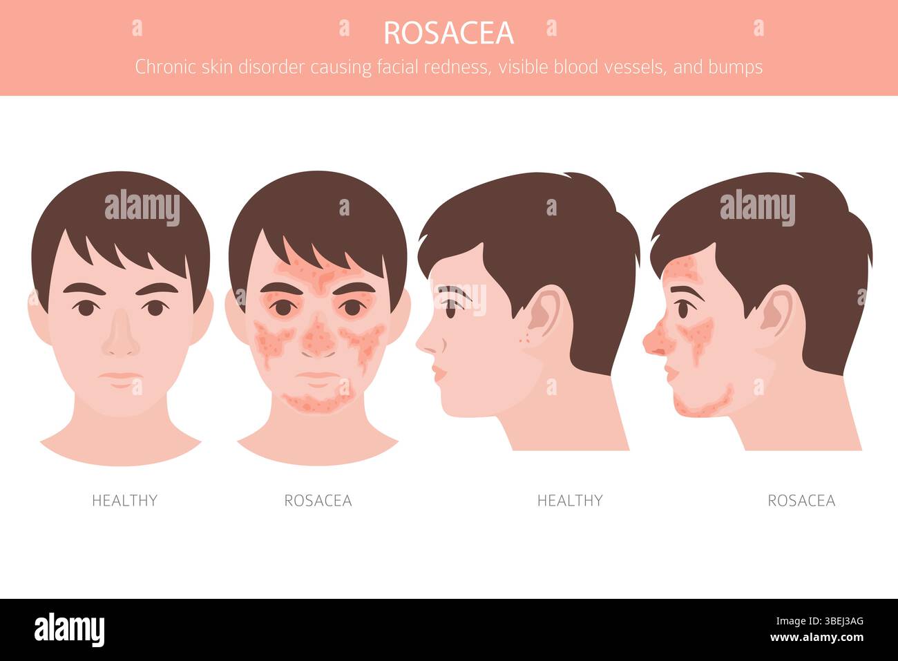 Rosacea. Skin diseases. Medical infographic design. Vector illustration ...