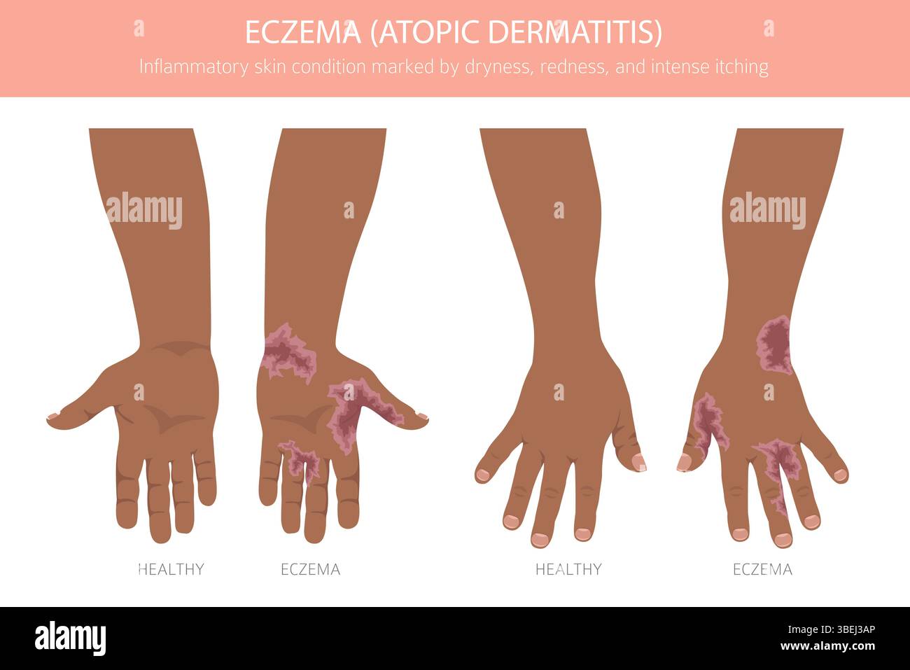 Eczema. Atopic dermatitis. Skin diseases. Medical infographic design ...