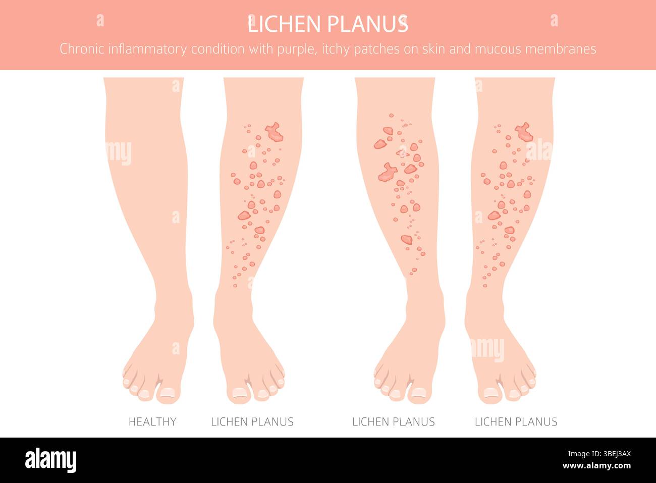Oral lichen planus Stock Vector Images - Alamy