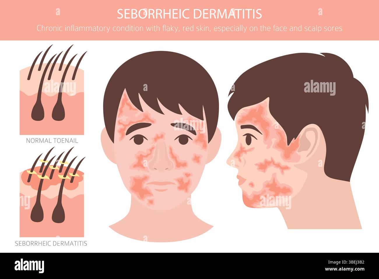 Seborrheic dermatitis. Skin diseases. Medical infographic design ...