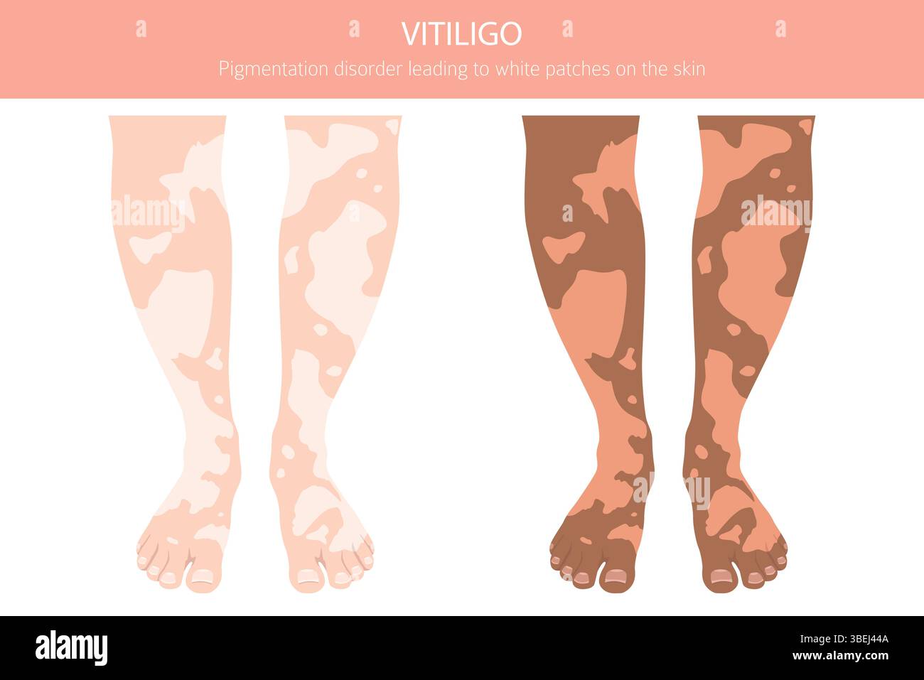 Vitiligo. Skin diseases. Medical infographic design. Vector ...
