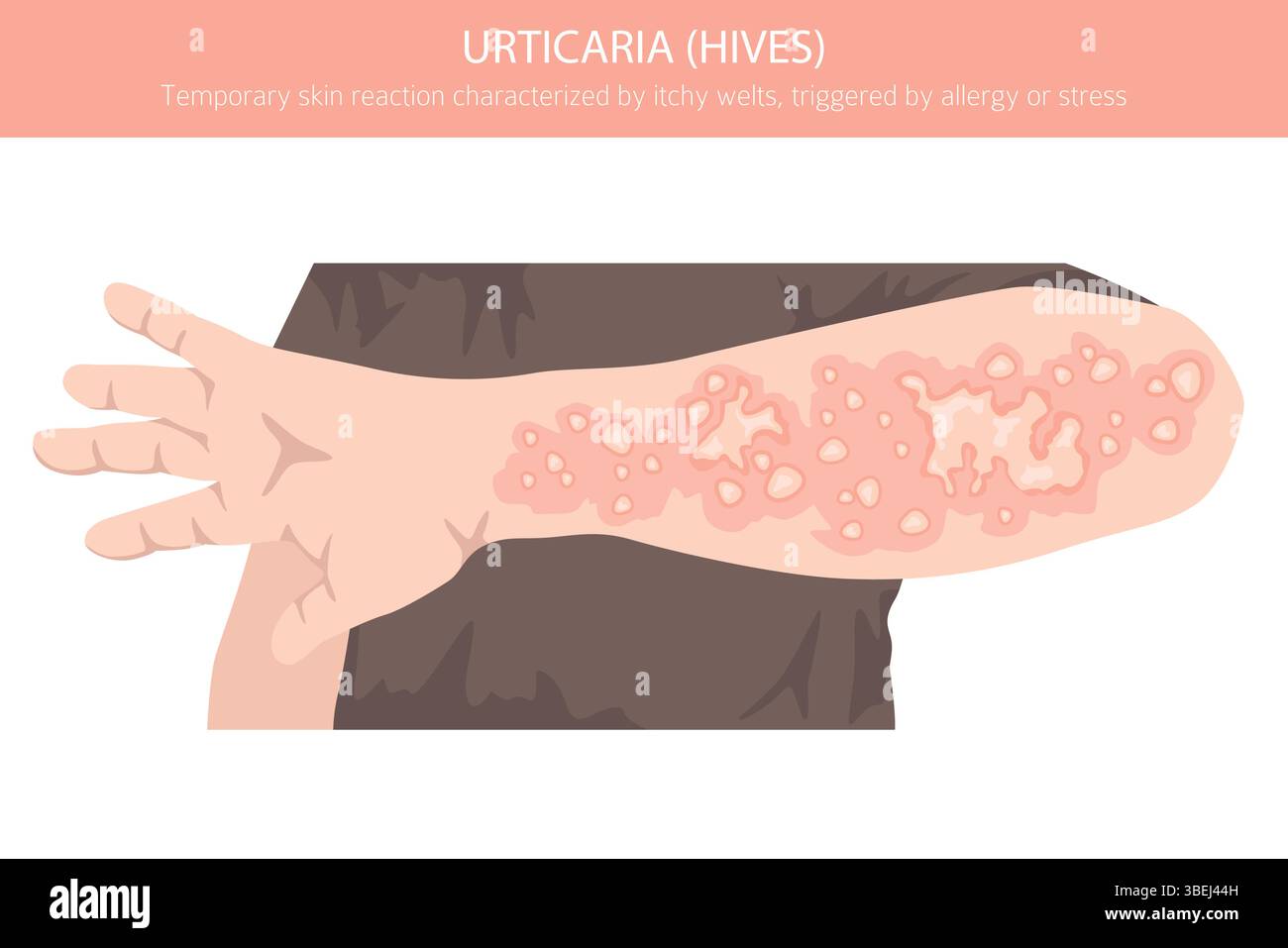 Urticaria. Hives. Skin diseases. Medical infographic design. Vector ...