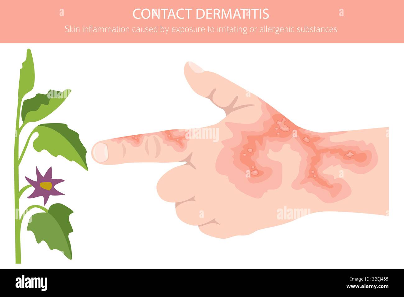 Contact dermatitis. Skin diseases. Medical infographic design. Vector ...