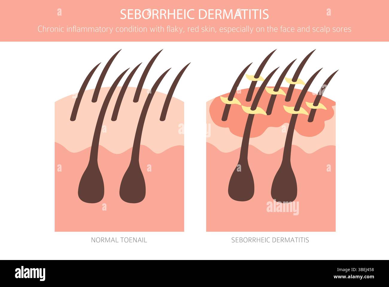 Seborrheic dermatitis. Skin diseases. Medical infographic design ...