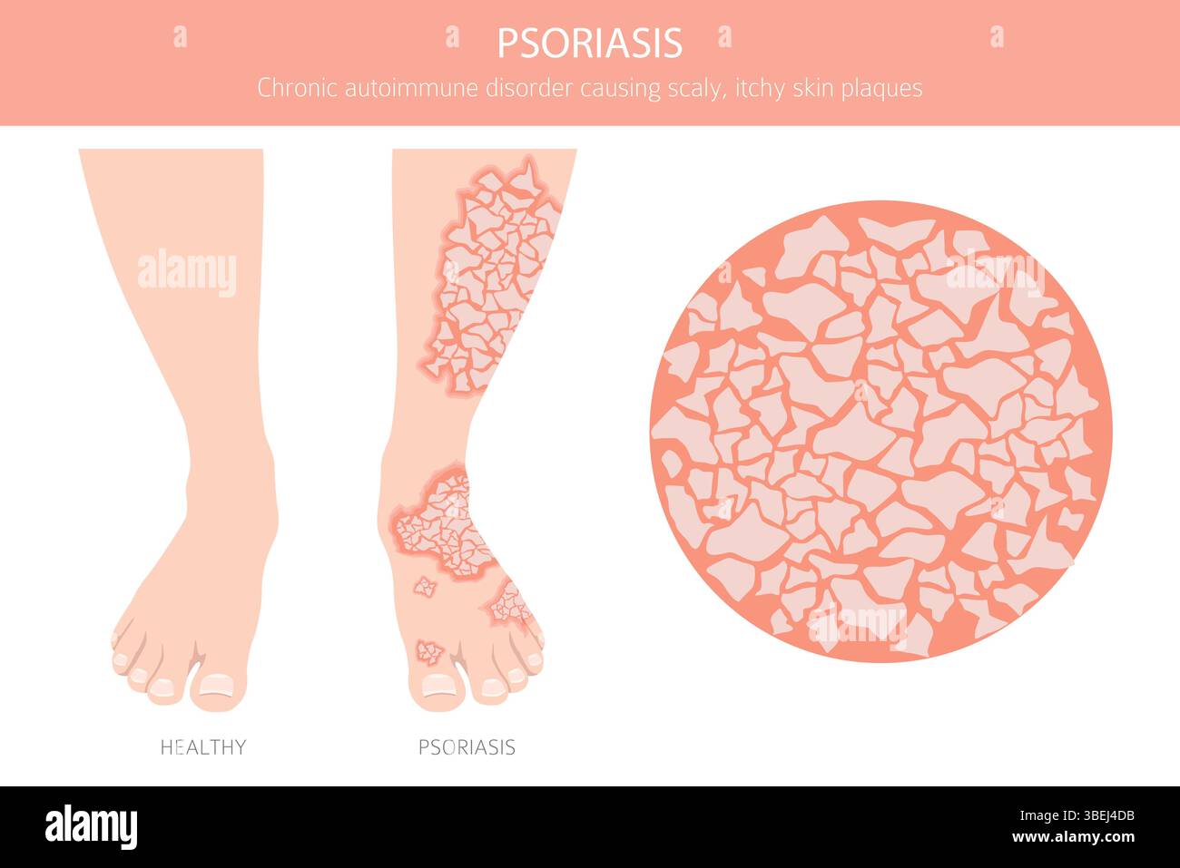 Psoriasis. Skin diseases. Medical infographic design. Vector ...