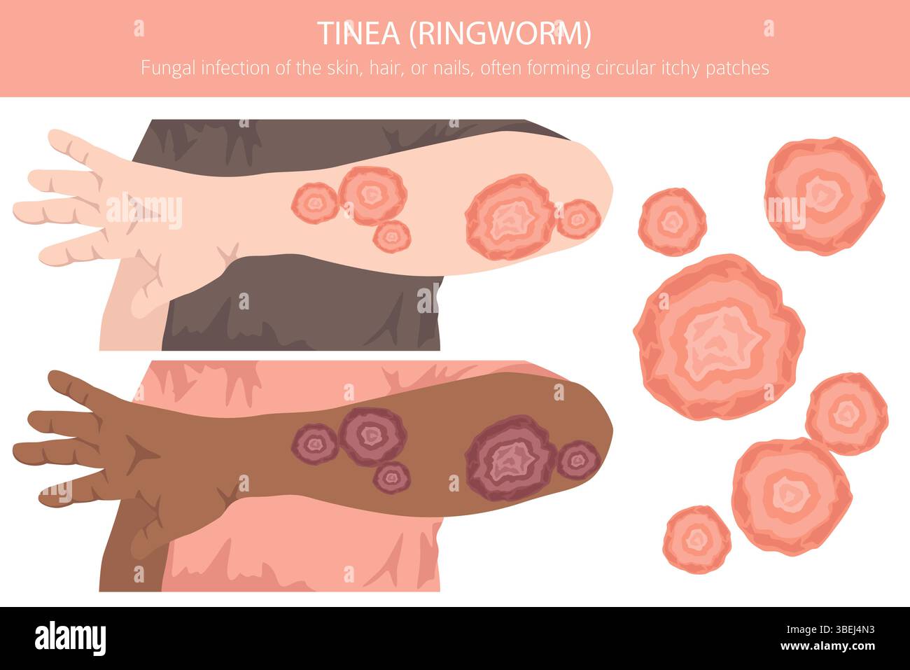 Tinea. Ringworm. Skin diseases. Medical infographic design. Vector ...