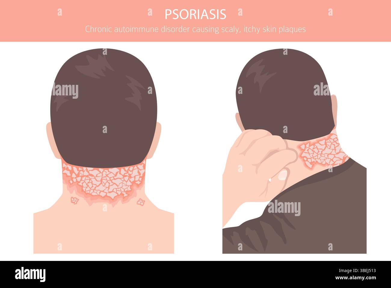 Psoriasis. Skin diseases. Medical infographic design. Vector ...