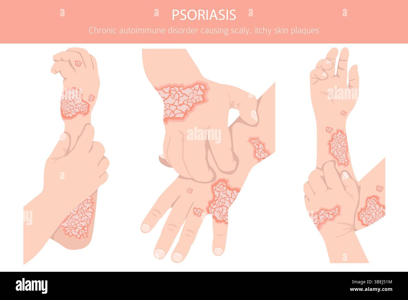 Psoriasis Skin Diseases Medical Infographic Design Vector 4809