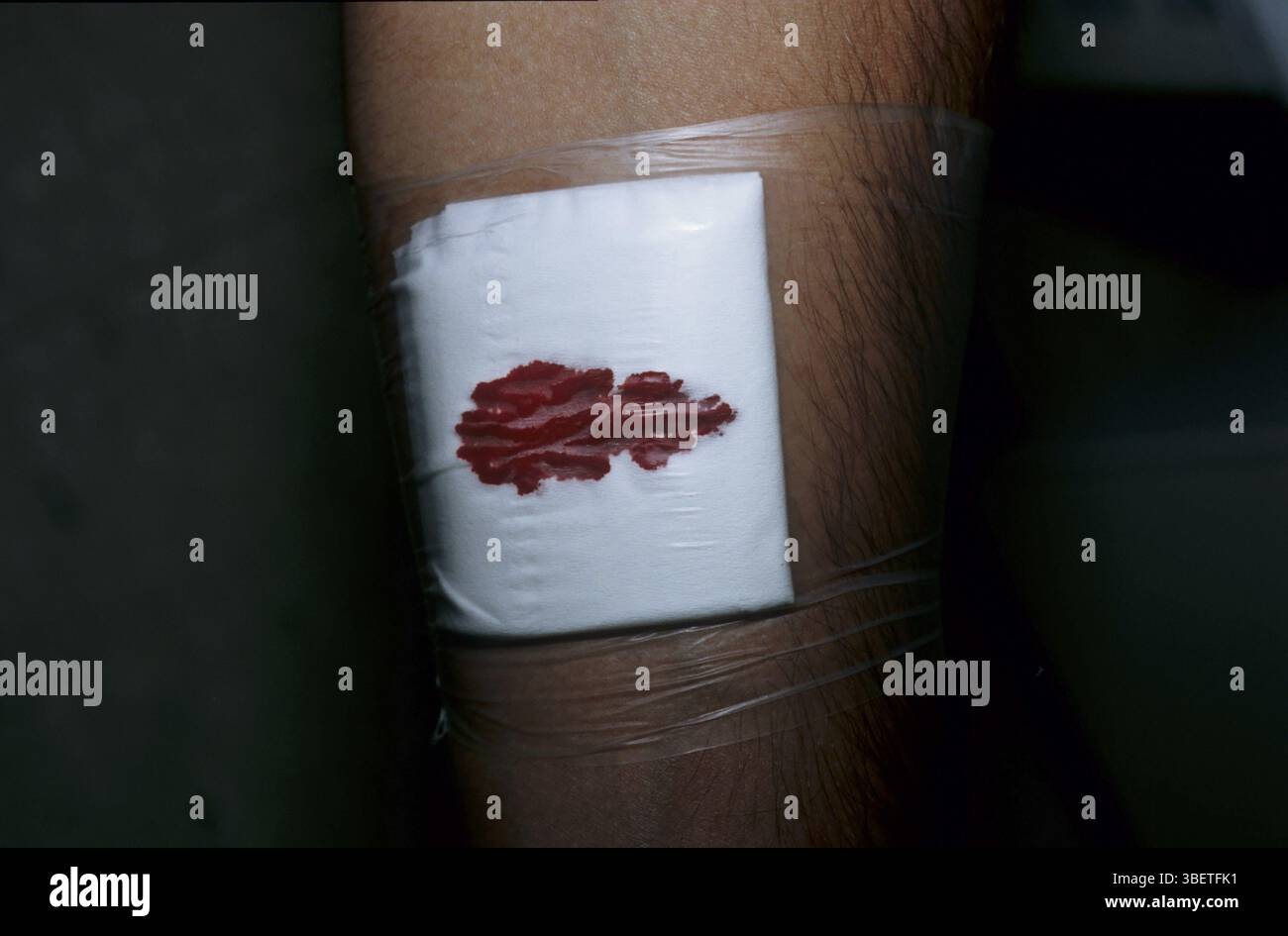 Leech bite hirudo medicinalis hi-res stock photography and images - Alamy