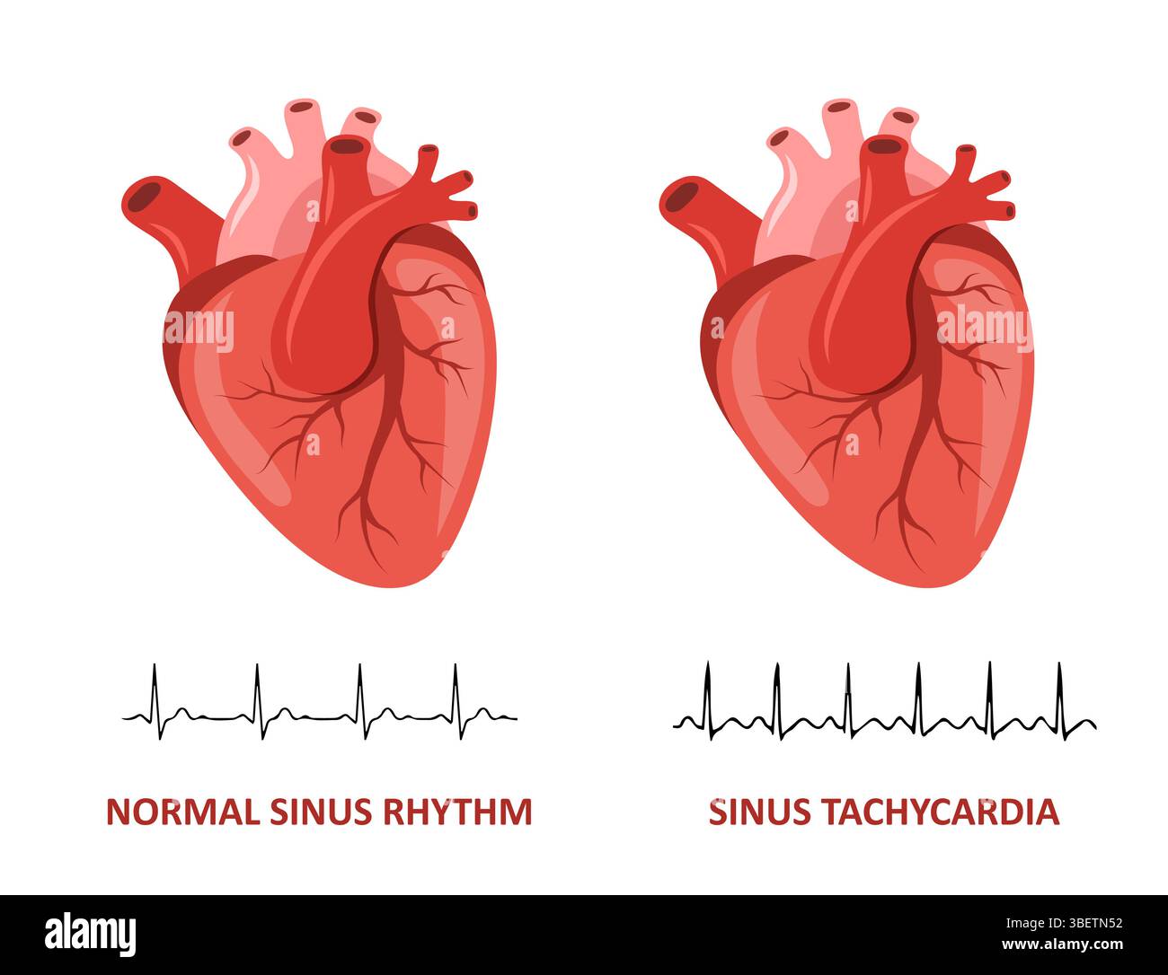 Heart diseases. Normal sinus rhythm and Sinus Tachycardia. Medical ...
