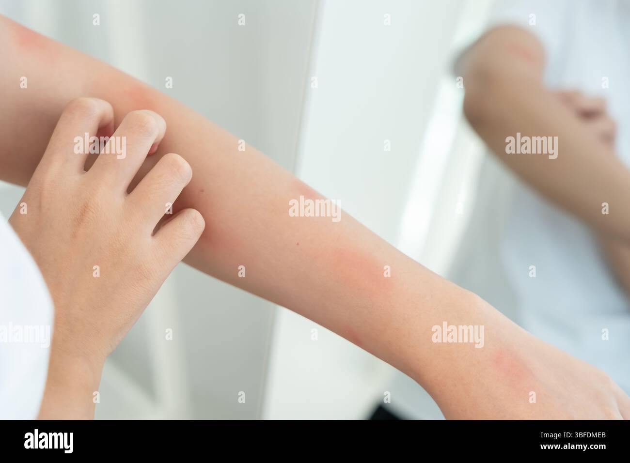 skin problem and beauty. Young woman scratch body has itchy skin from ...