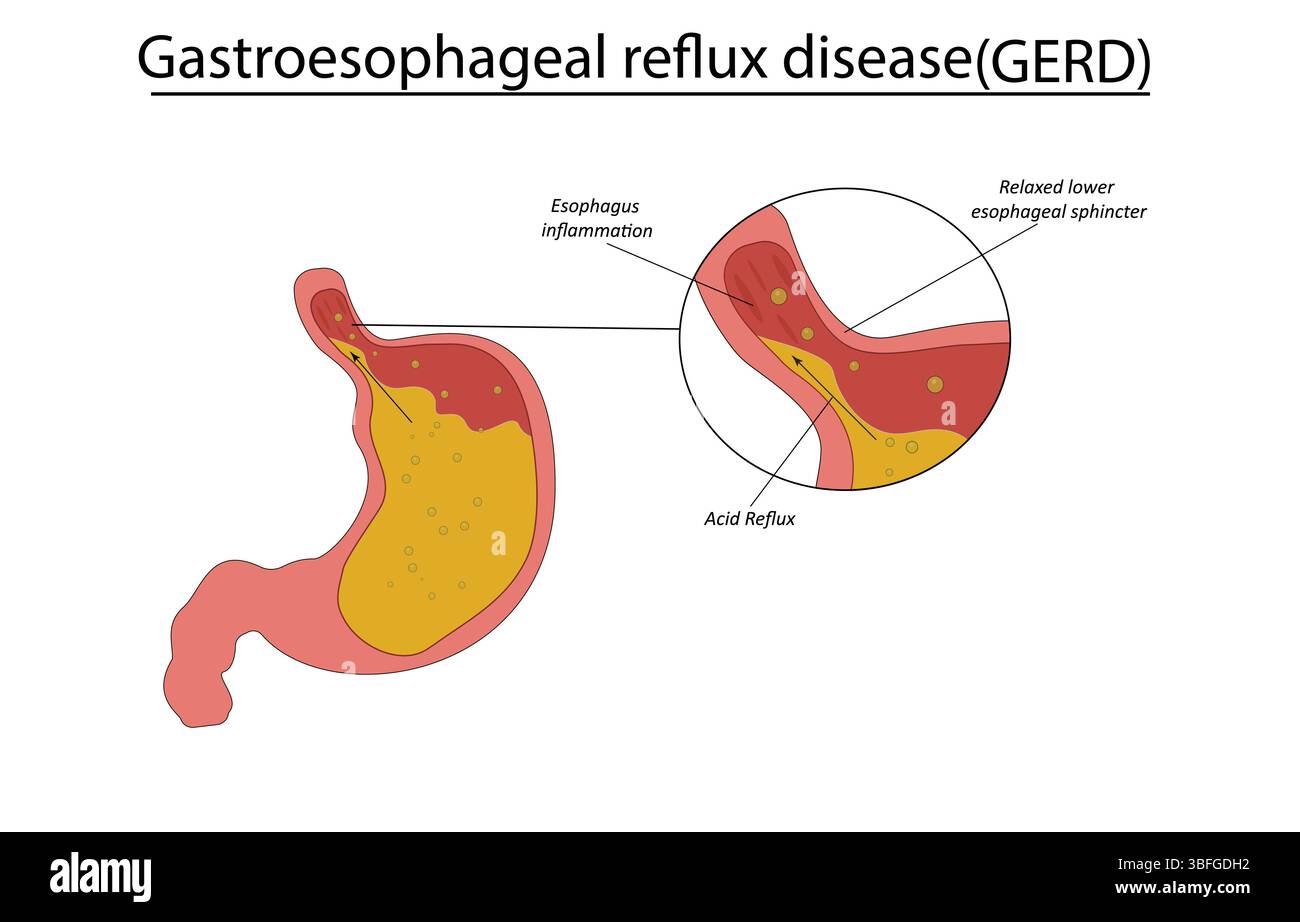 Gastroesophageal reflux disease(GERD) vector illustration Stock Vector ...
