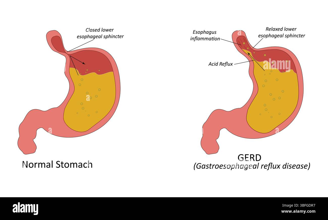 Gastroesophageal reflux disease(GERD) vector illustration Stock Vector ...