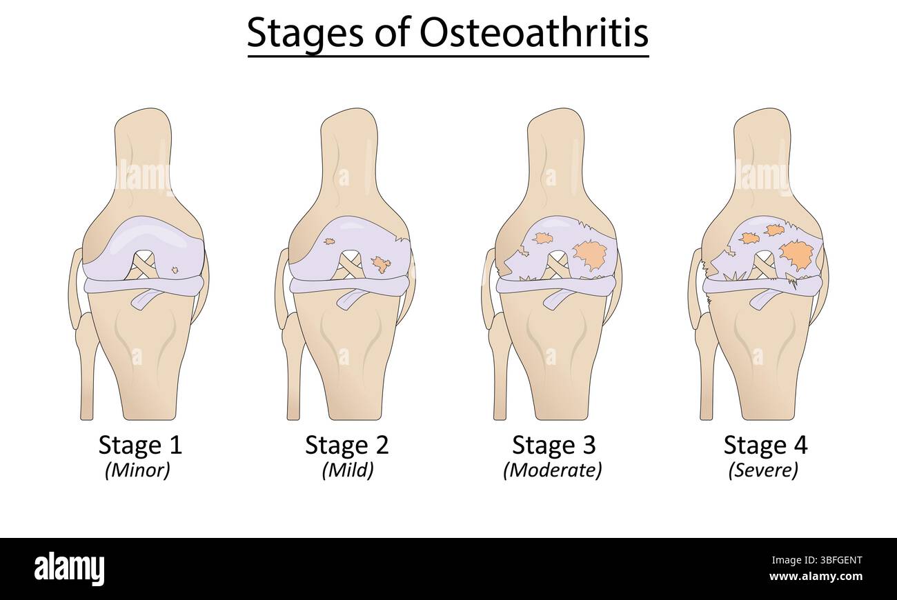 Stages of osteoarthritis vector illustration Stock Vector Image & Art ...