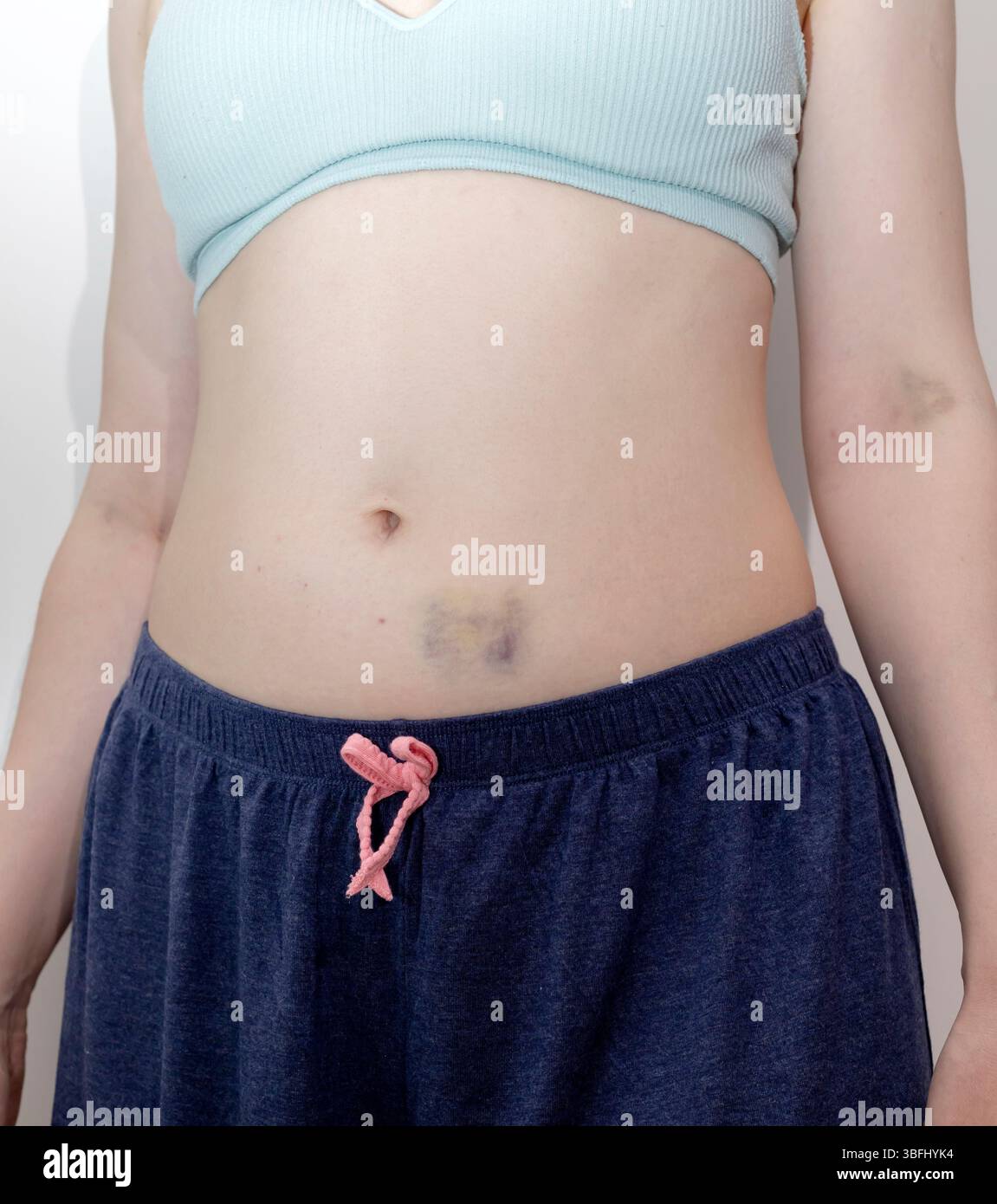 Closeup Human Abdominal Area And Hands With Hematoma, Bruise After ...