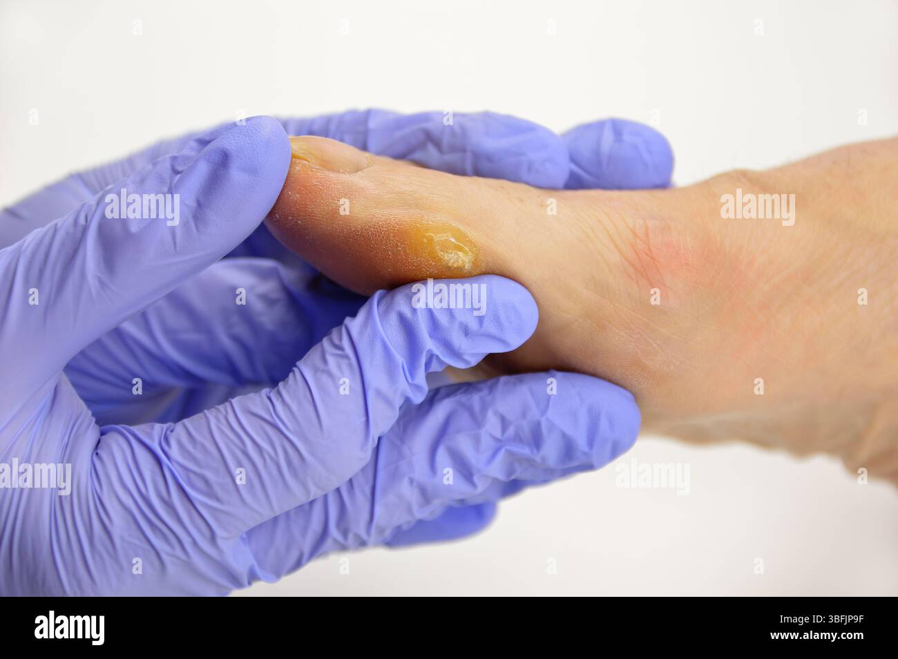 Close-up image of doctor checking the foot callus suffering.Horizontal ...