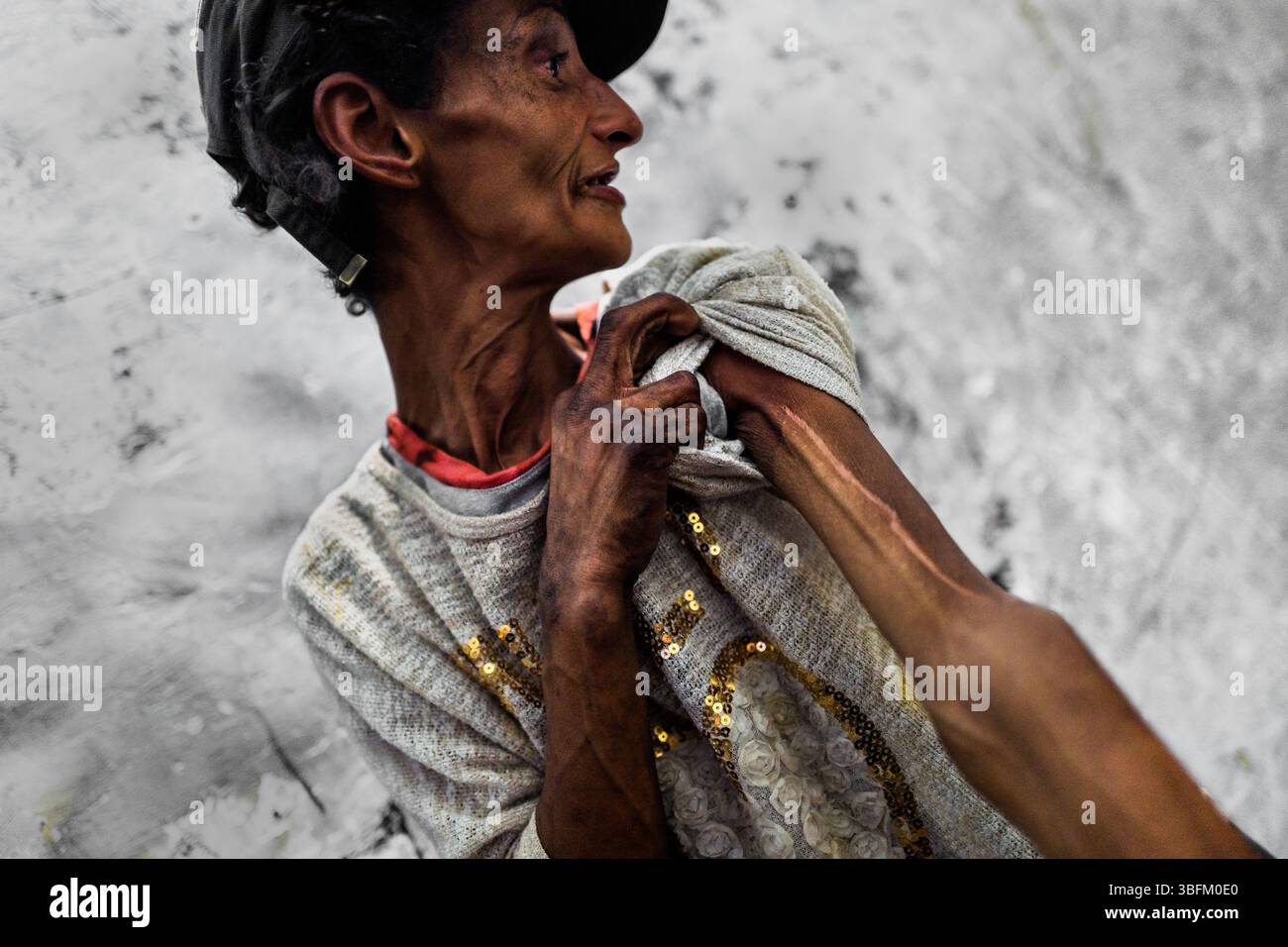 A Colombian drug user shows a large scar on her arm caused by a knife ...
