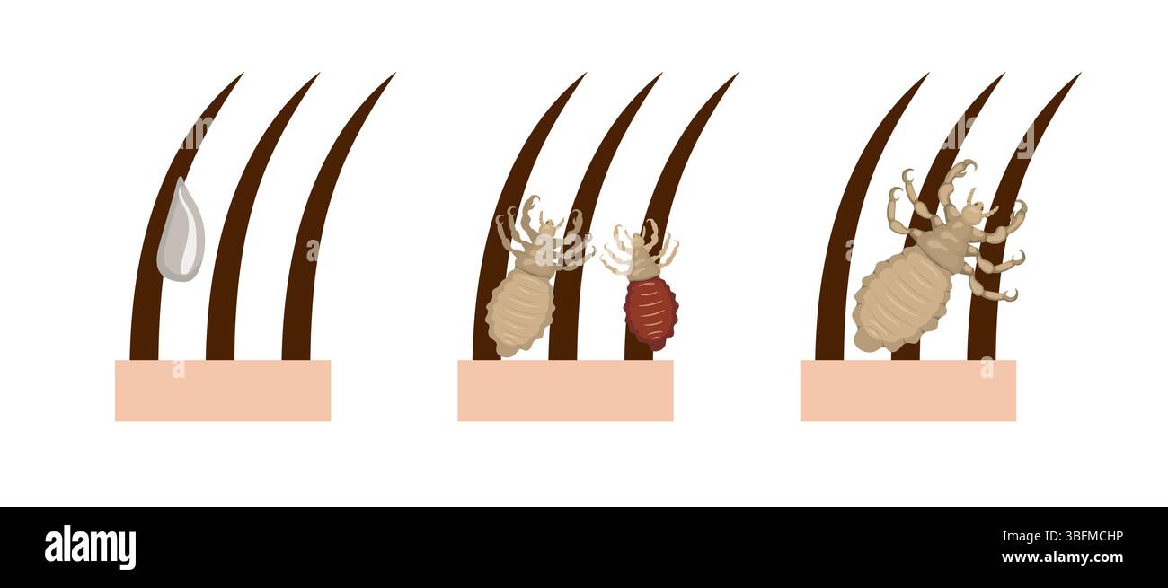 Illustration of a head louse with nits attached to hair strands, infestation and the life cycle ...